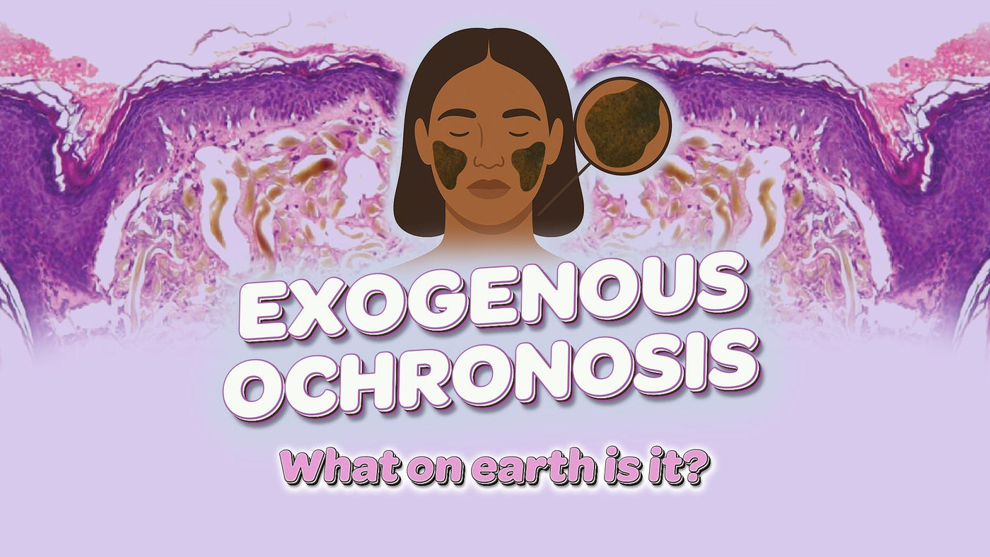 Exogenous Ochronosis