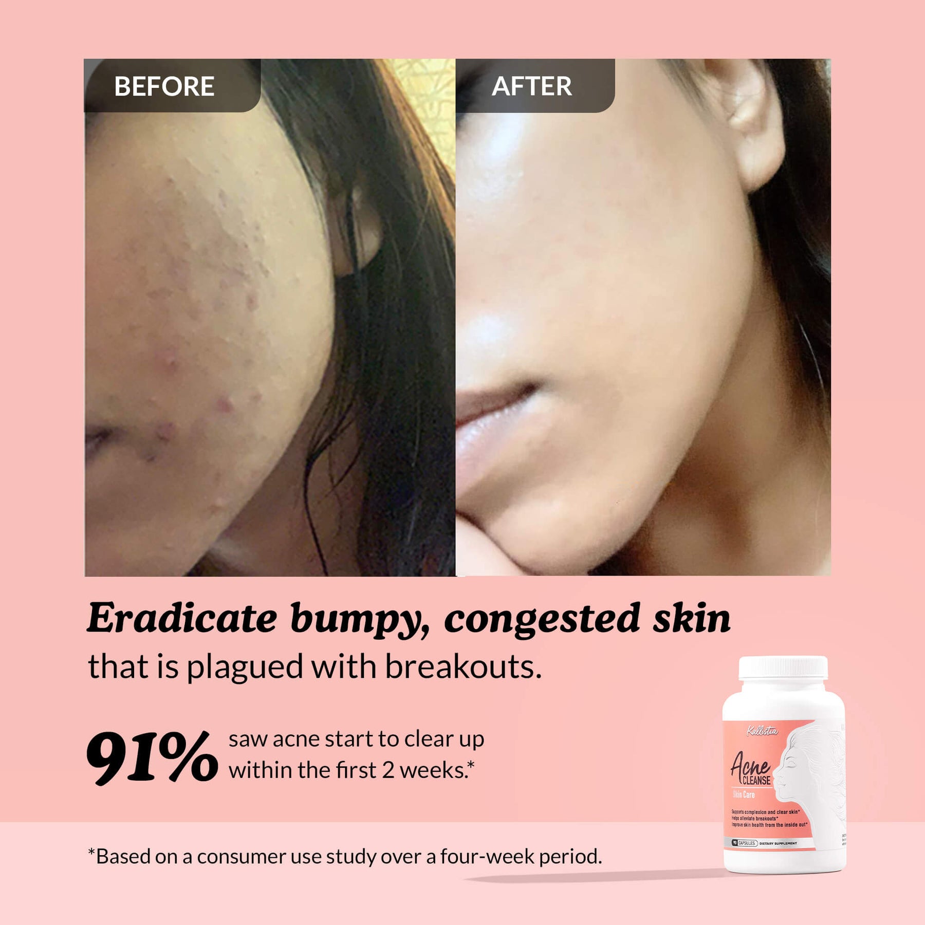 Acne Cleanse Capsules | kallistia