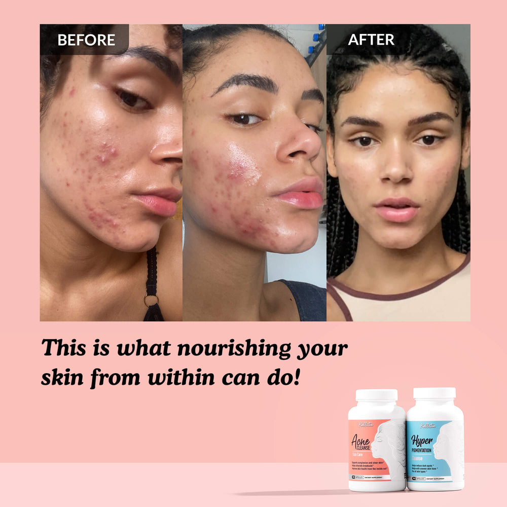 Clear Complexion Kit | kallistia