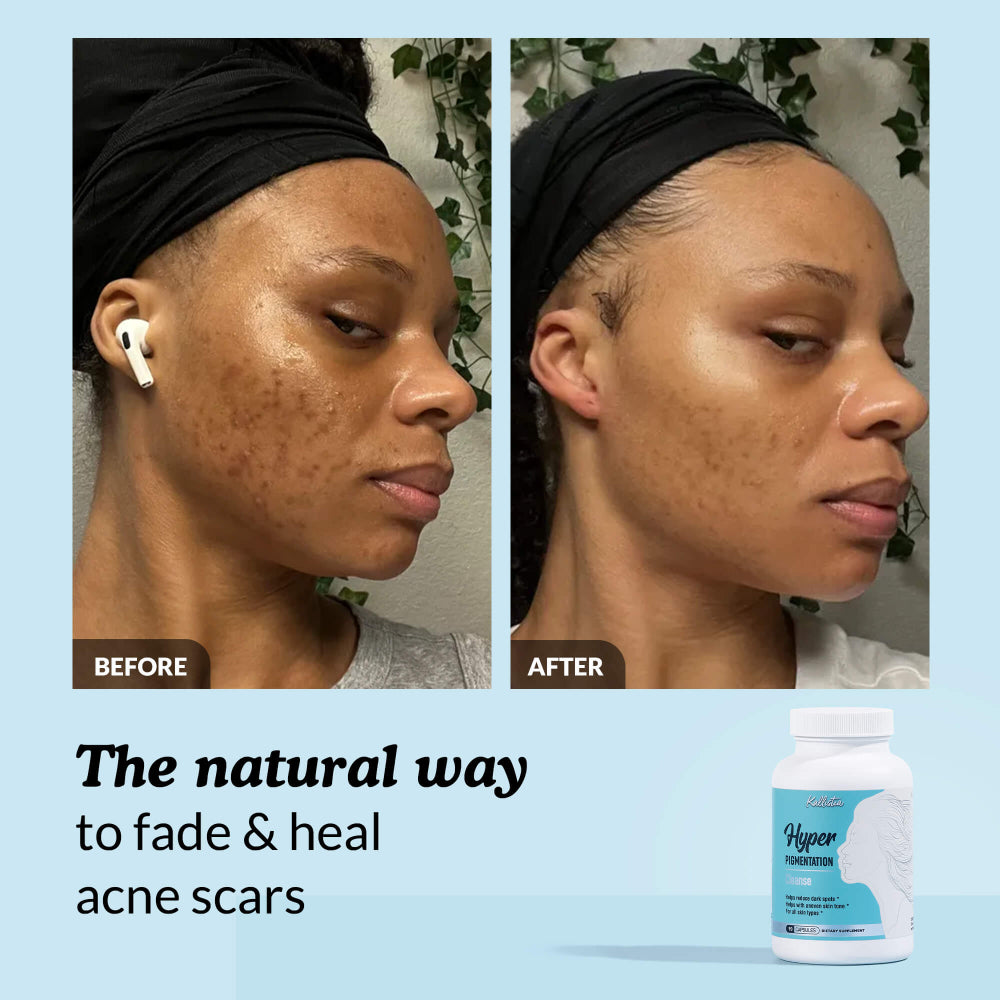 Hyperpigmentation Cleanse Capsules | kallistia