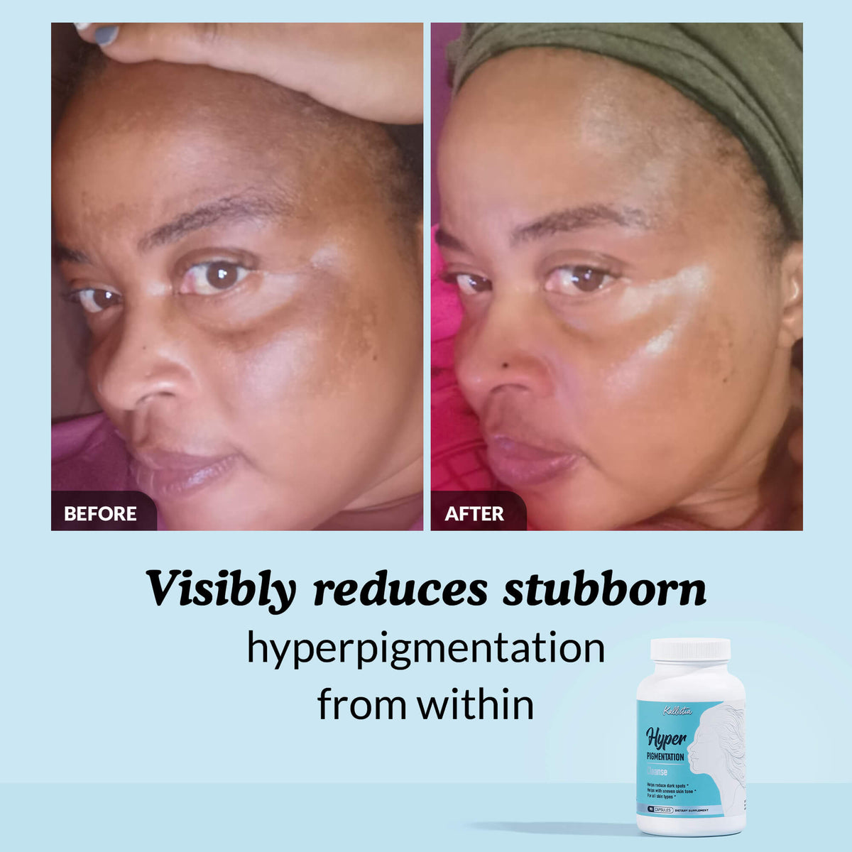 Hyperpigmentation Cleanse Capsules Kit | kallistia